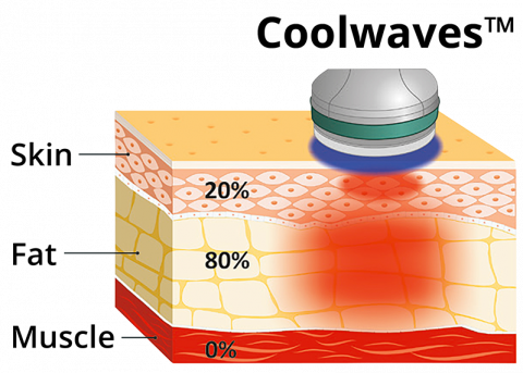 Body Contour | Lasermed